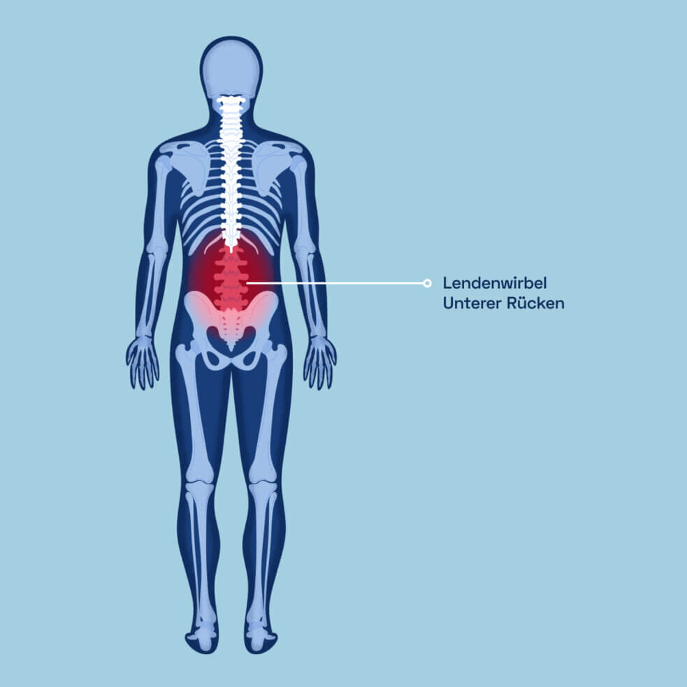 Rückenschmerzen: Ursachen, Behandlung und Symptome | Kaia