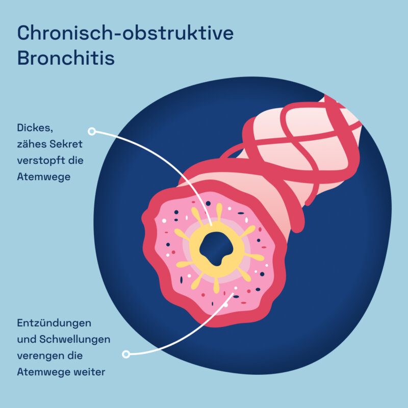 COPD: Ursachen, Behandlung und Symptome | Kaia Health